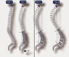 Un médecin du sport vous informe: les 4 types de dos et leur prise en ...
