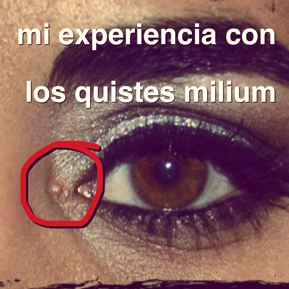 Lala Shadow: Mi experiencia con los quistes milium