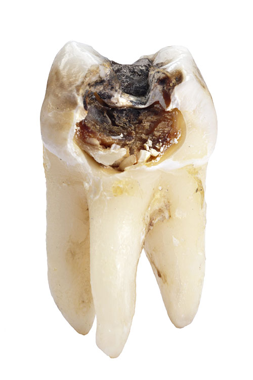 Çürük nedir? İlgili atasözleri deyimler ve anlamları ne demektir? - Laf ...