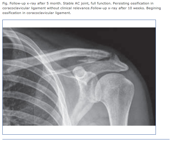 Shoulder and Elbow Surgery: "Shoulder Separation" or Collar bone ...