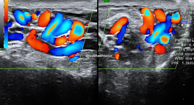 SONO DIGEST: TESTICULAR DOPPLER ; VARICOCELES - COLOR & SPECTRAL DOPPLER