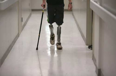 Nothing To Do With Arbroath: First double leg-transplant patient has ...