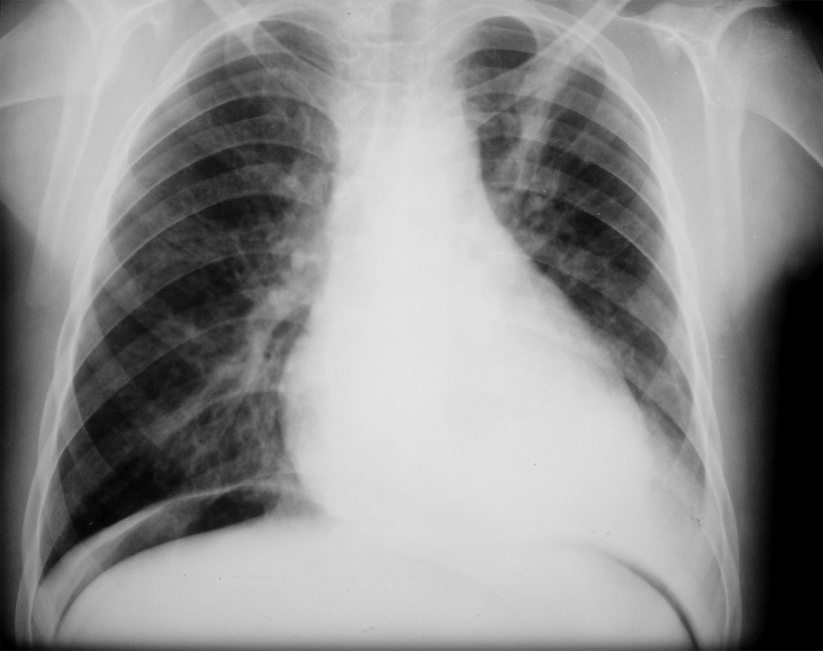 Perfuração intestinal - Doença de Crohn e Colite Ulcerativa