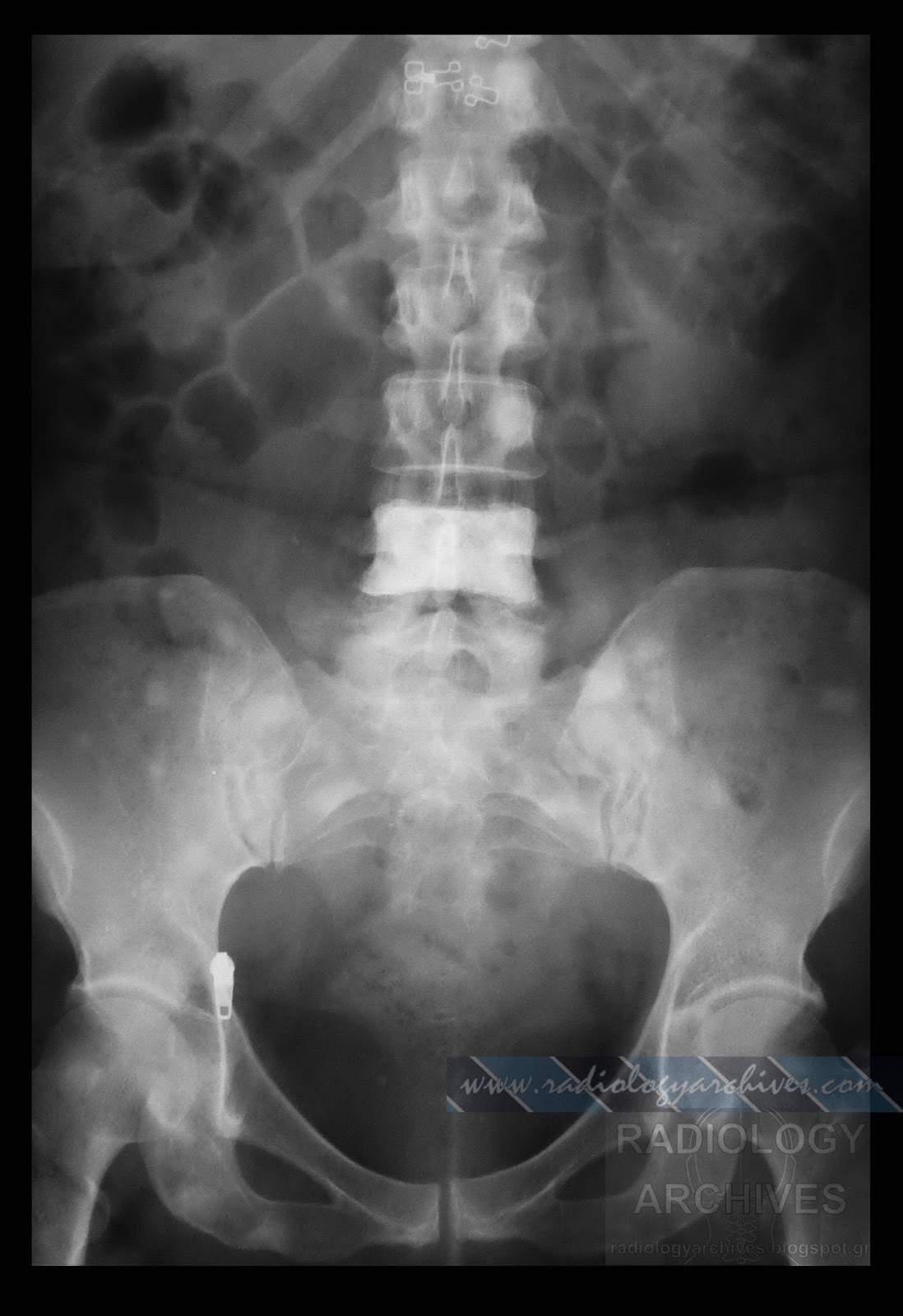 Radiology Archives: Ivory Vertebra Sign (Οστεοβλαστικές Μεταστάσεις)