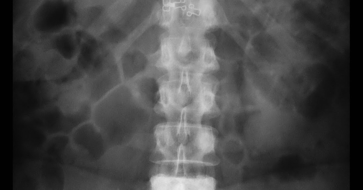 Radiology Archives: Ivory Vertebra Sign (Οστεοβλαστικές Μεταστάσεις)