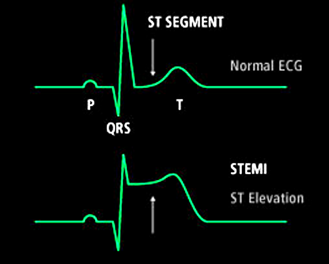 Asuhan Gizi pada Pasien STEMI Inferior Dextra