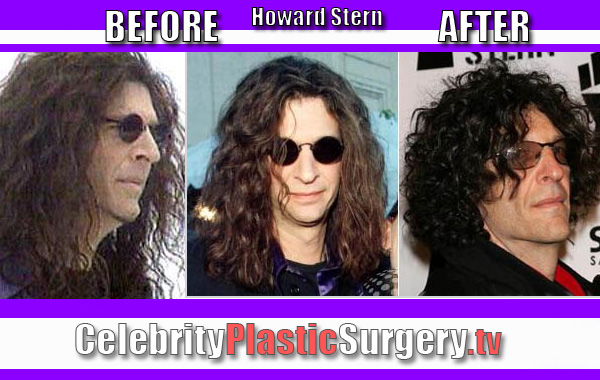 Howard Stern Facelift and Facial Skin Plastic Surgery Before and After ...