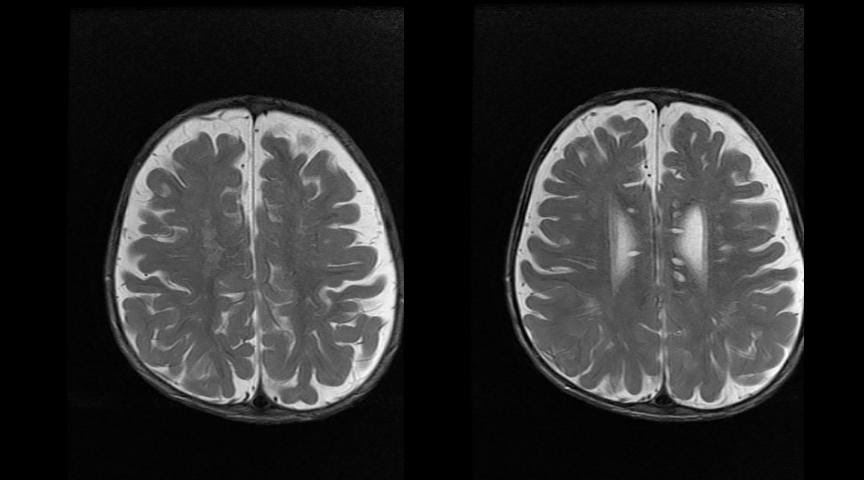Dr Balaji Anvekar FRCR: Mucopolysaccharidosis MRI Brain