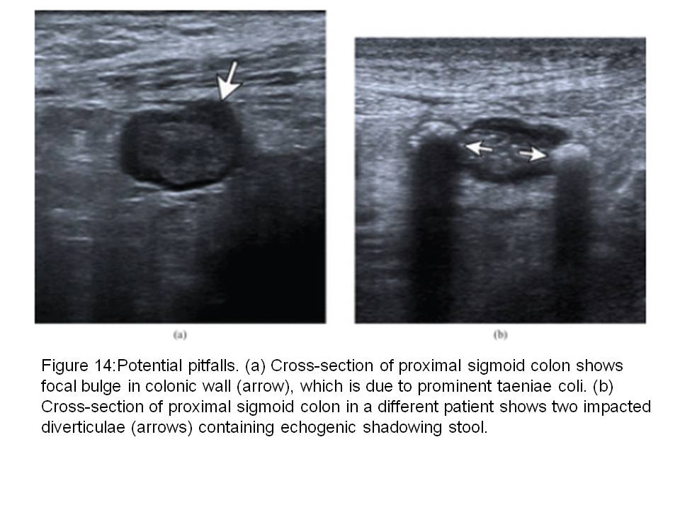 BÀI SOẠN VỀ SIÊU ÂM CHẨN ĐOÁN: COLONIC POLYPS: US DETECTION