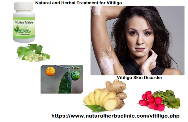 Vitiligo: its Complications, Symptoms and Natural Herbal Treatment ...