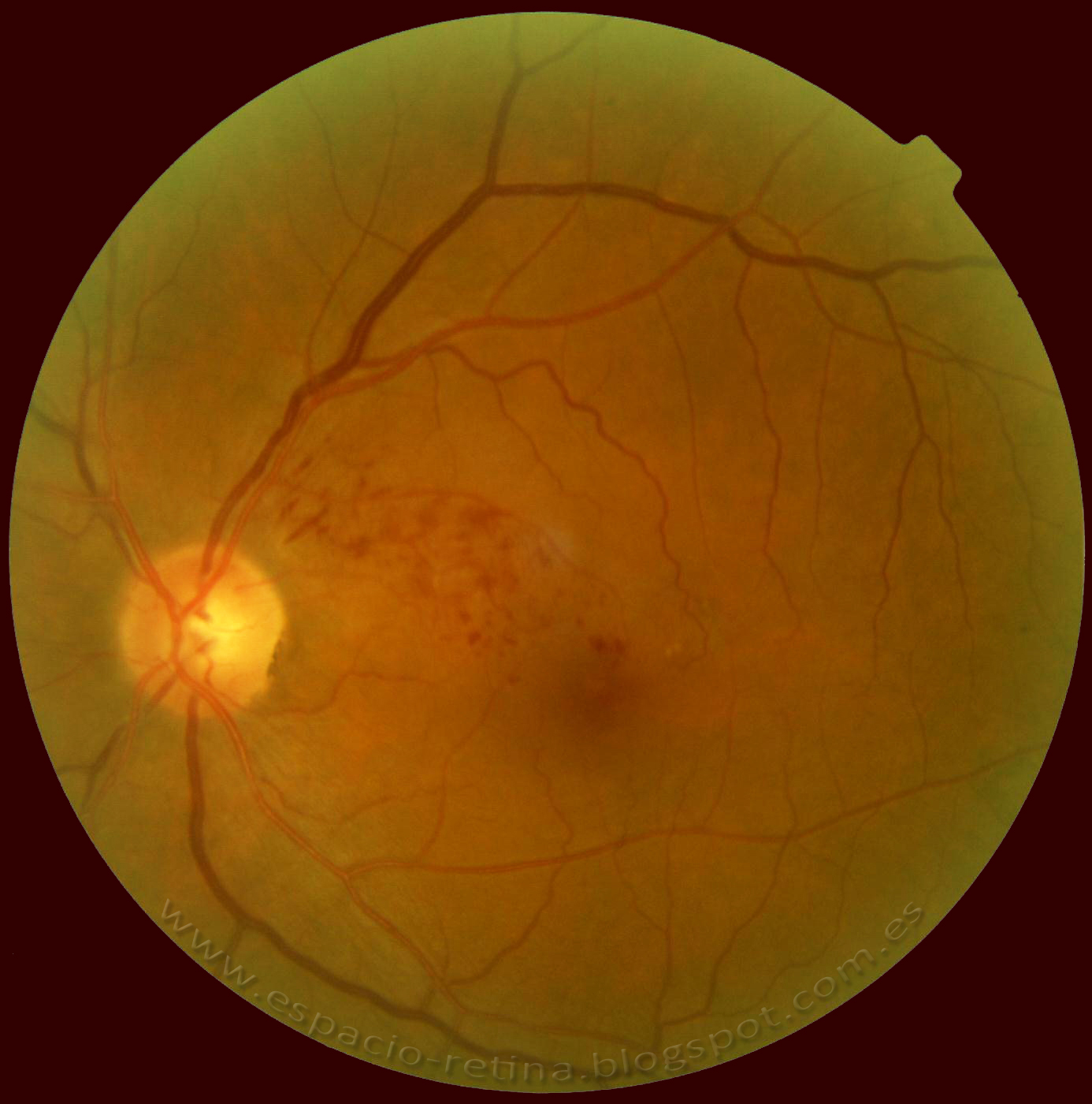 ESPACIO RETINA: Retinopatía HTA.
