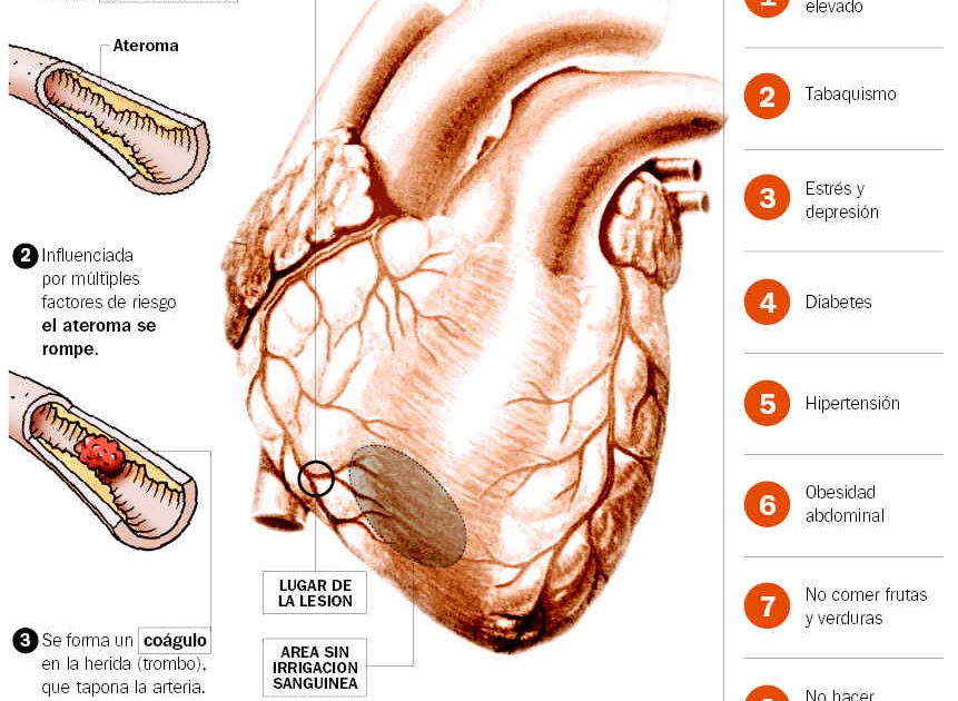 Medicina: Infarto Agudo del Miocardio