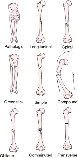 Comminuted Fracture | Comminated Bone Fracture Treatment