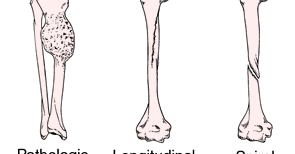 Comminuted Fracture | Comminated Bone Fracture Treatment