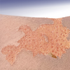 sikkahoder: mengenal berbagai bentuk kelainan pada kulit