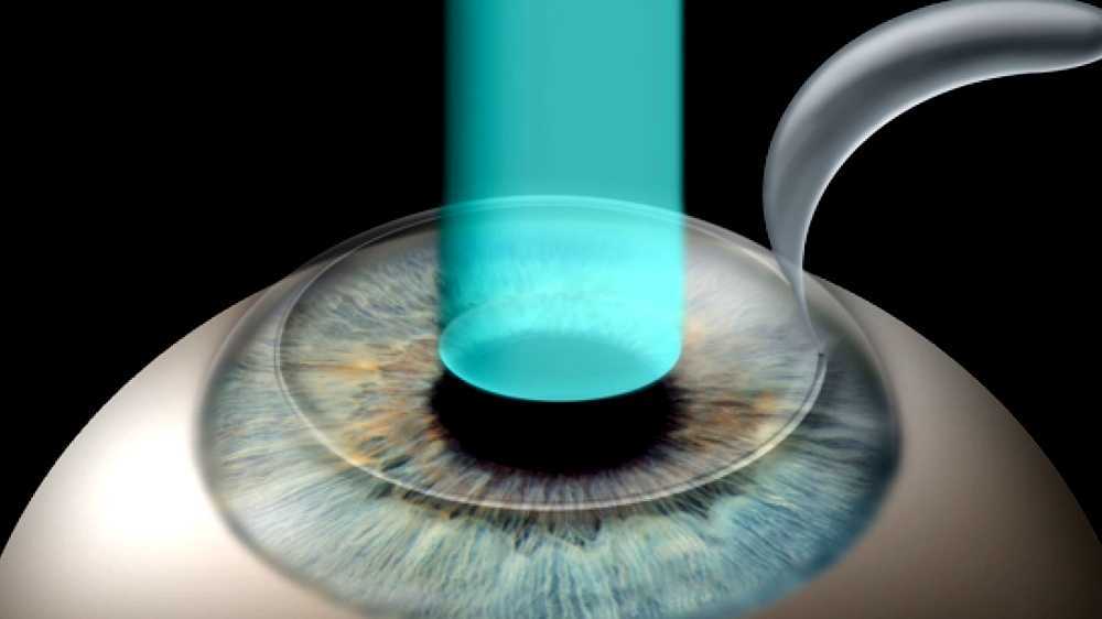 Refractive surgery