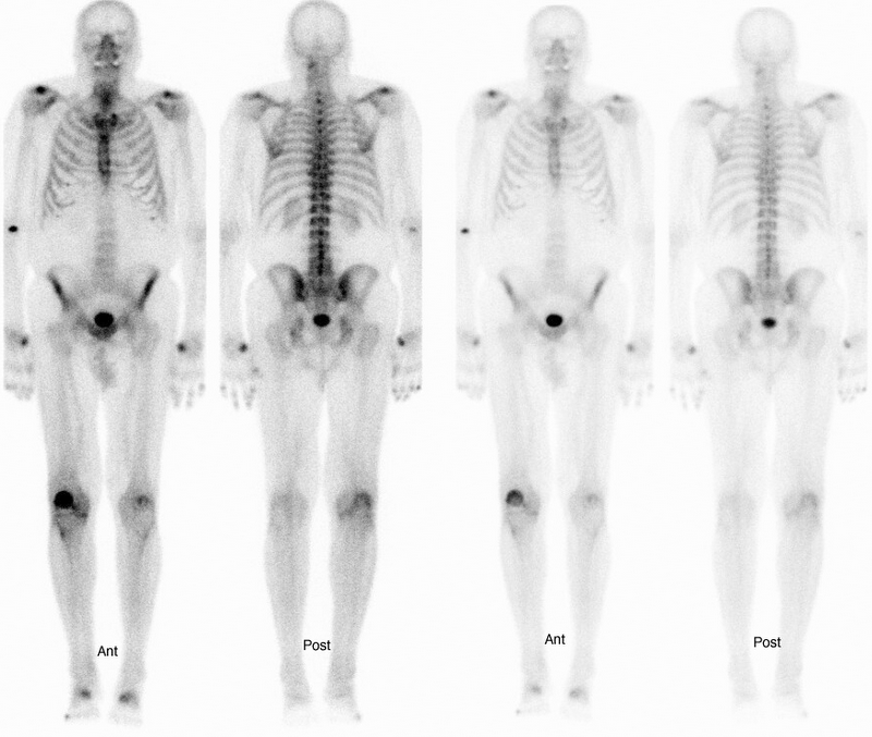 MedicineNet : Lung Cancer
