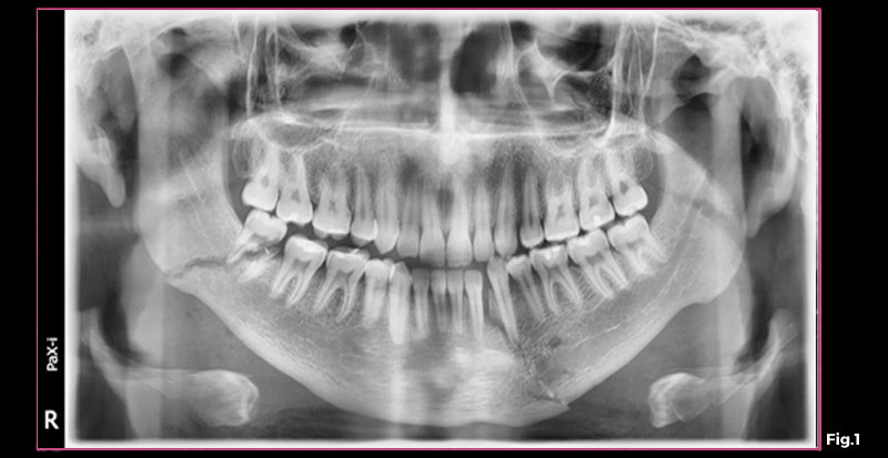 radiología en odontología : RADIOGRAFÍAS DENTALES