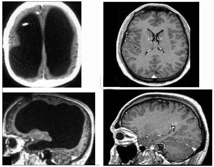 La semaine du cerveau et l'homme au cerveau creux ~ Sweet Random Science