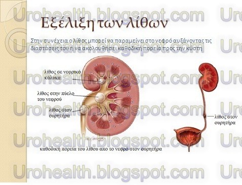 ΛΟΥΤΣΑΡΗΣ ΚΩΝΣΤΑΝΤΙΝΟΣ ΧΕΙΡΟΥΡΓΟΣ ΟΥΡΟΛΟΓΟΣ: ΛΙΘΟΙ ΤΟΥ ΟΥΡΟΠΟΙΗΤΙΚΟΥ