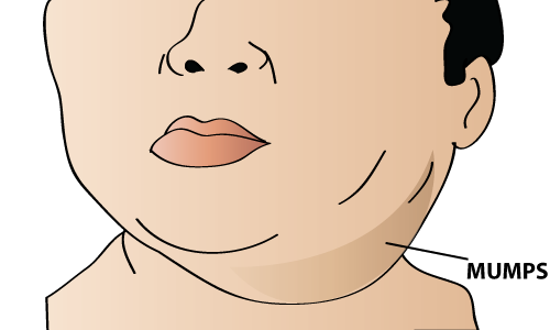 Laxmi Homeo Clinic: Mumps Parotitis treatment and remedies