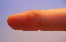 Photos of Warts on Hands and Fingers ~ How To Remove Moles, Warts, Skin ...