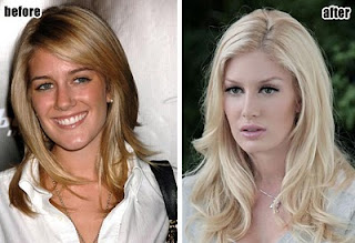 CELEBRITIES: Heidi Montag Plastic Surgery Before and After Pictures 2012