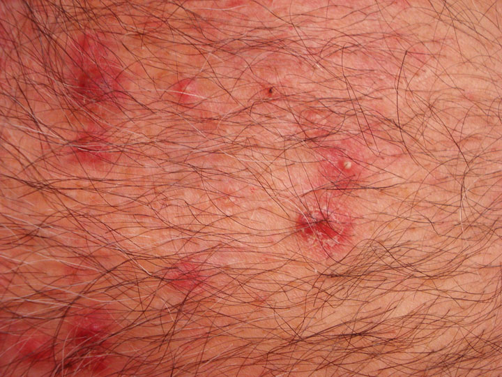 VIRTUAL GRAND ROUNDS IN DERMATOLOGY 2.0: Chronic Localized Folliculitis