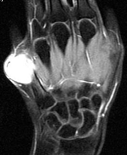 BPOP versus differentials - Sumer's Radiology Blog