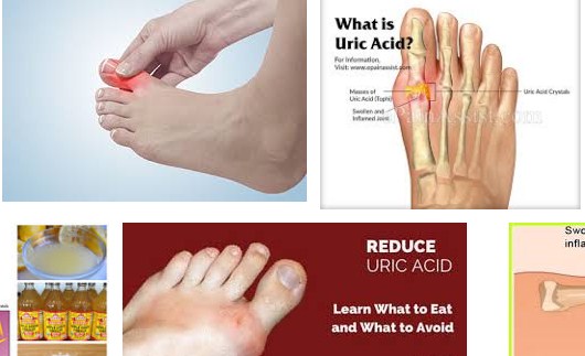 Pengertian Asam Urat | Cara Obat Asam Urat