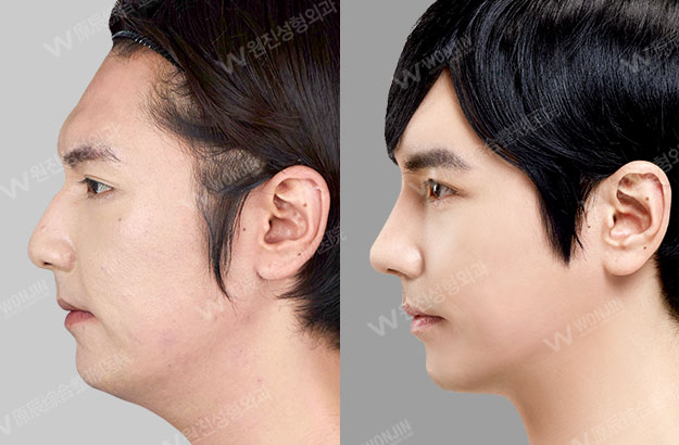 Operasi hidung dan operasi pengecilan cuping