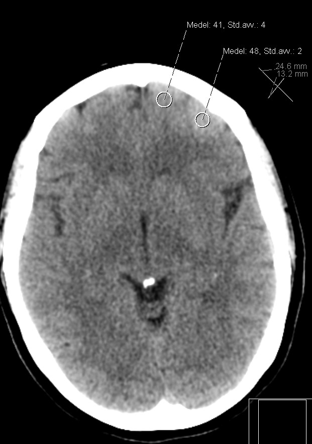 Incidental Meningioma