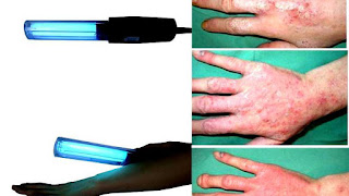 Ultraviolet light therapy