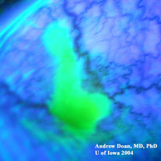 Case of the Day: Teardrop