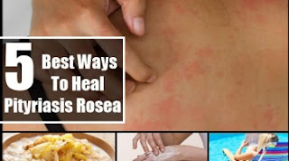 How to Treatment Pityriasis Rosea Fast ~ wellviser
