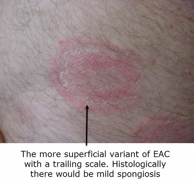 Dermatopathology Made Simple - Inflammatory: Superficial and Deep ...