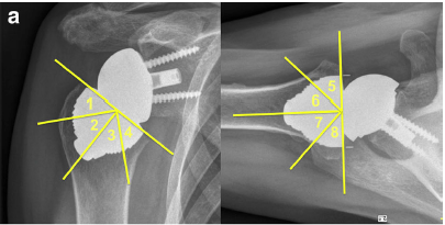 Shoulder Arthritis/Joint Replacement Rotator cuff tears: Stemless ...