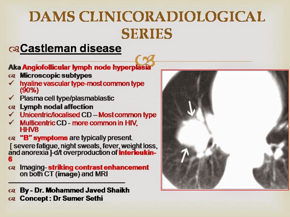 Castleman's Disease- Clinicoradiological Series - Sumer's Radiology Blog