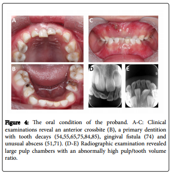 Mutation Survey of the PHEX Gene and Oral Manifestation in a Chinese ...