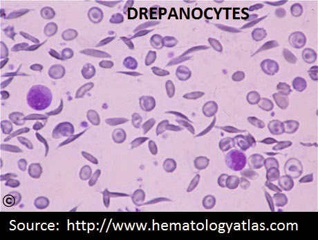 Lab Atlas: Drepanocytes