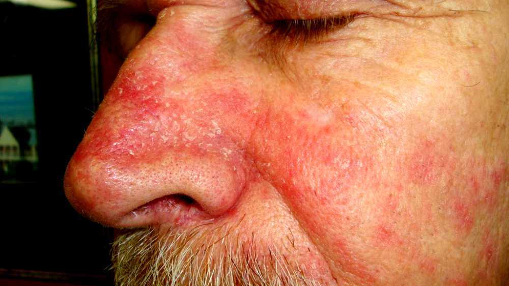 Seborrhoeic dermatitis