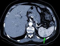 SURGSEMINAR: RUPTURED SPLEEN
