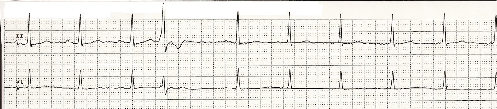 EKG Rhythm Strips 52
