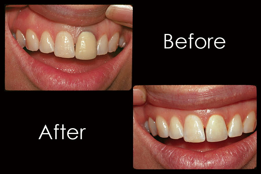 Dr. Robert G. Tupac: Prosthodontics: Single Tooth Prosthodontics