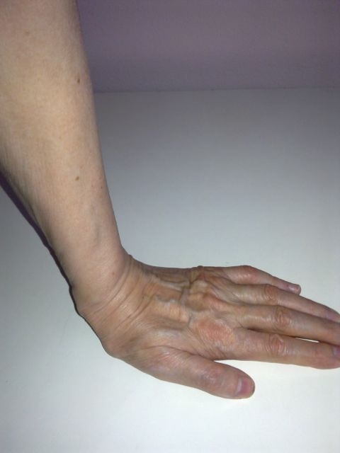 Handrehabilitationcase with Dupuytren's contracture.: A trauma in the ...