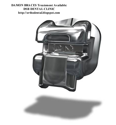 DAMON System Braces by: DSB DENTAL CLINIC: Are Damon braces really ...