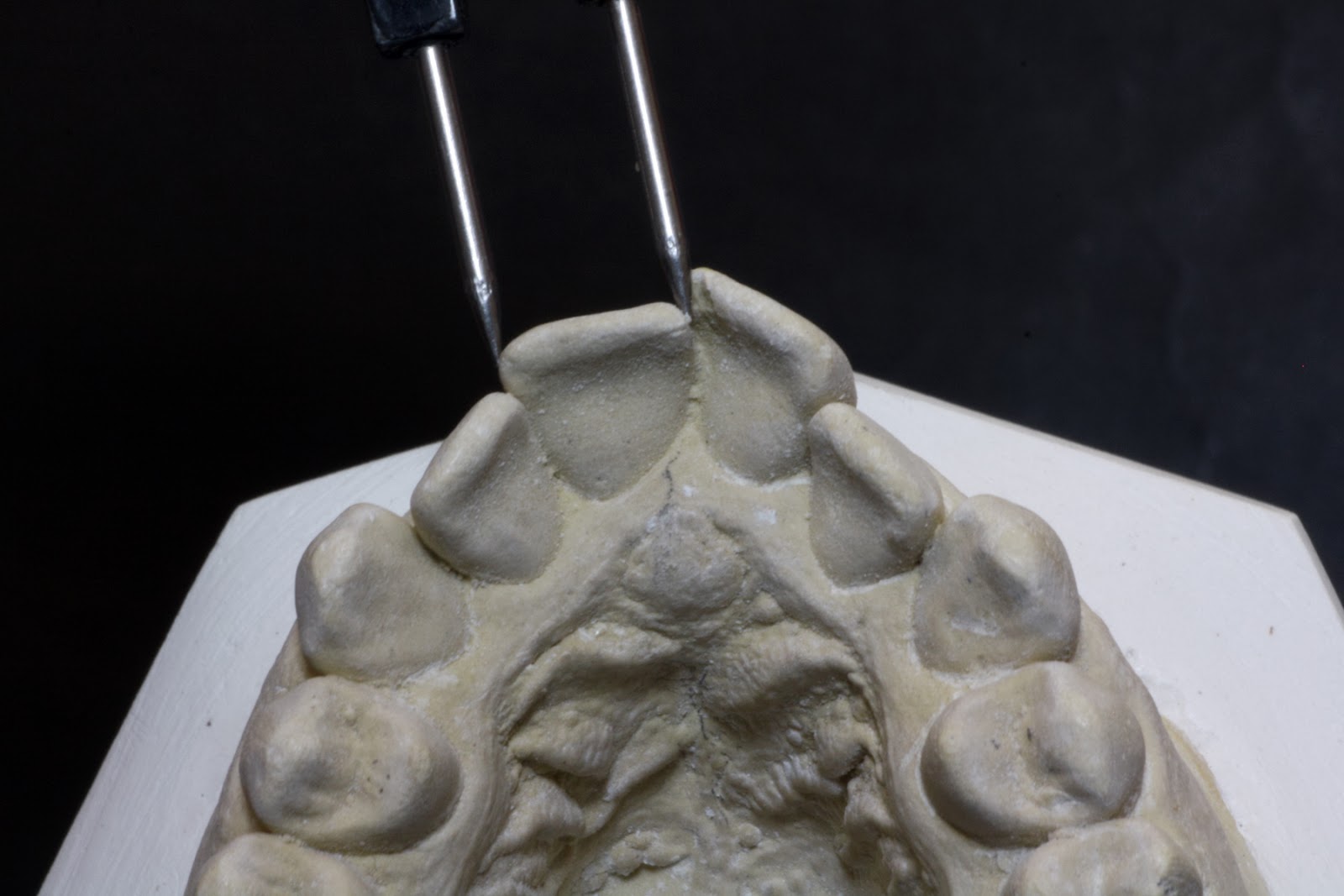 Orthodontics: UG Model Analysis Tooth width measurement