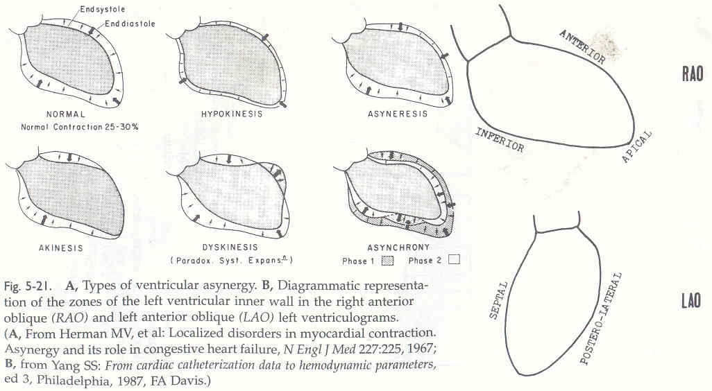 Pedi cardiology: Cath: Left Ventriculogram