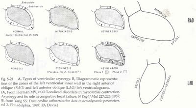 Pedi cardiology: Cath: Left Ventriculogram