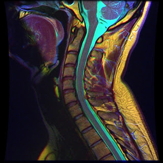 Nevit's blog: Color MRI of Cervical vertebrae